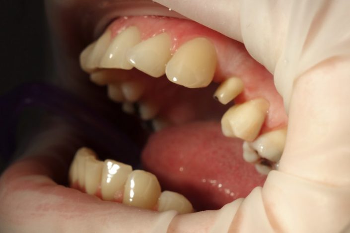 Fixed prosthetics – Our clinical cases - Melita Franko, dr. dent. med.